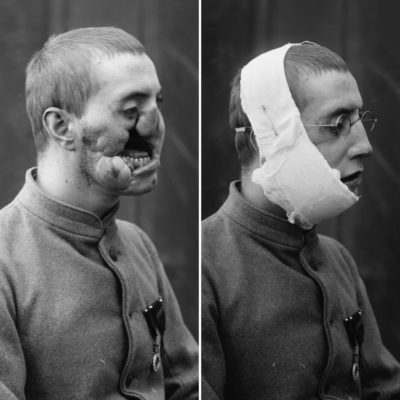 The American Woman Who Sculpted New Faces for Battle-Scarred WWI Vets