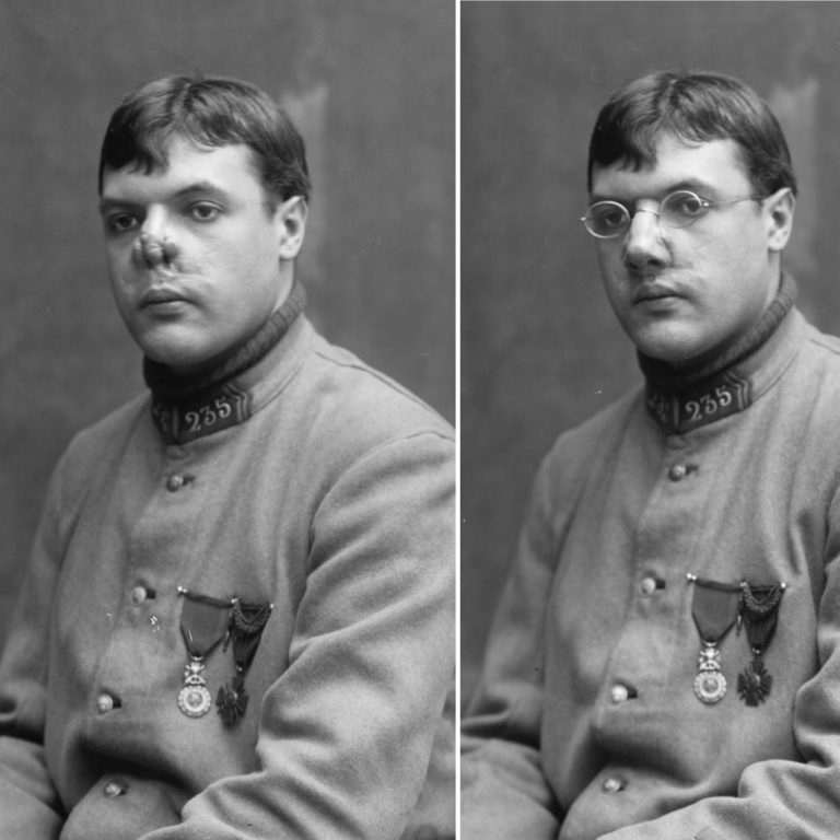 The American Woman Who Sculpted New Faces for Battle-Scarred WWI Vets
